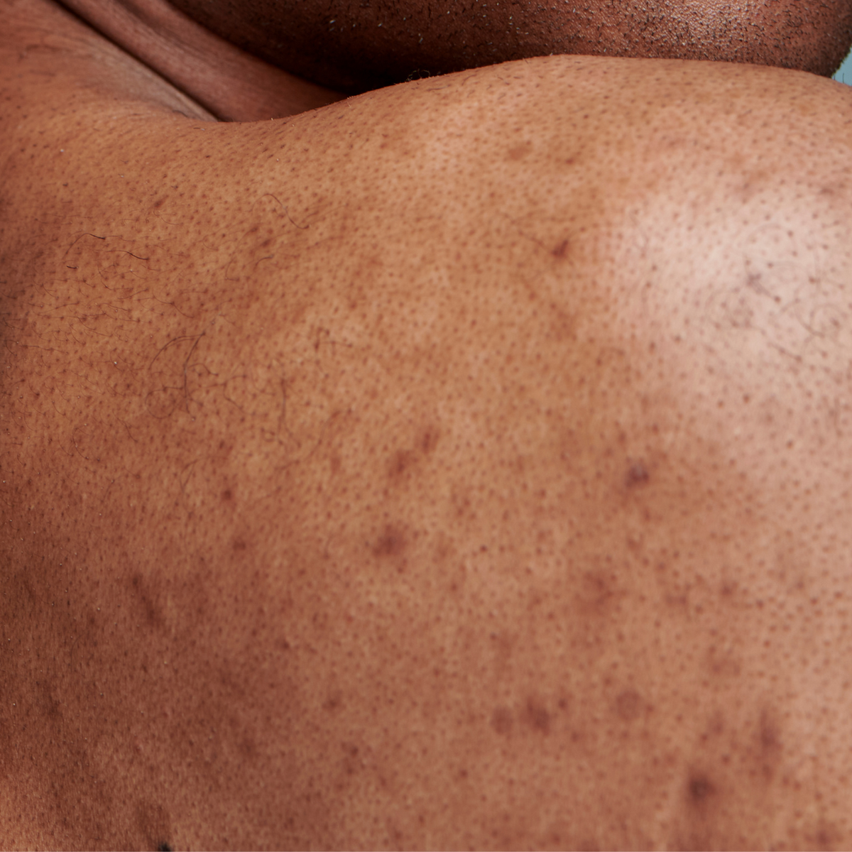 What is Hyperpigmentation in Men and How Do We Get It? – Age of Super